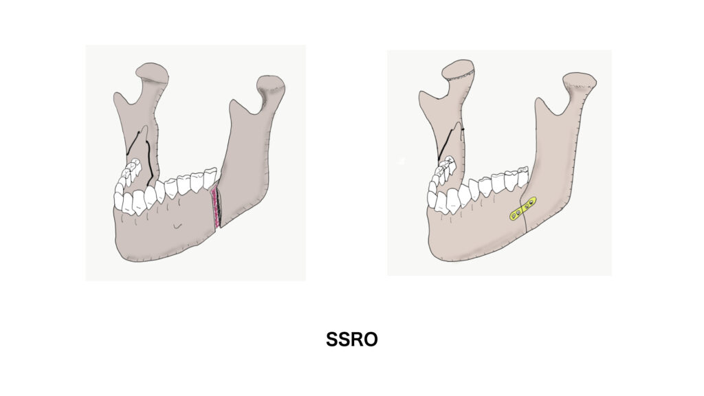 SSROとIVRO - 淀川キリスト教病院 形成外科・小児形成外科